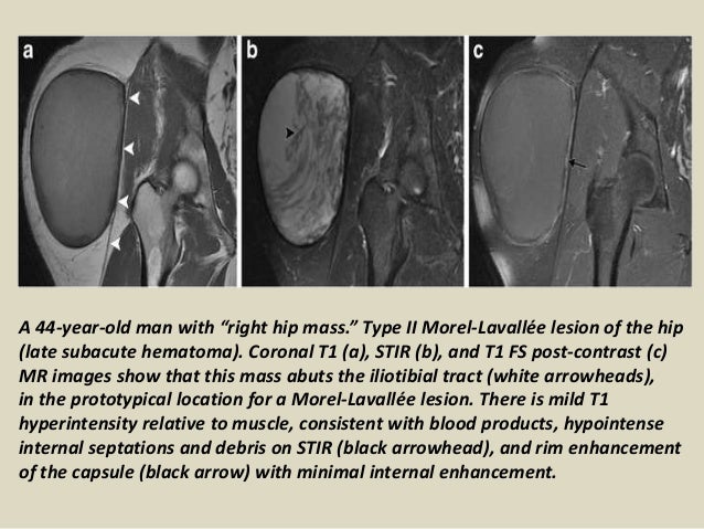 Presentation1, radiological imaging of morel lavallee lesion.