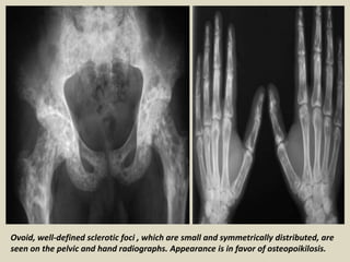 Presentation1, radiological imaging of ostepopikilosis | PPTX