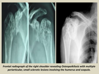 Presentation1, radiological imaging of ostepopikilosis | PPTX