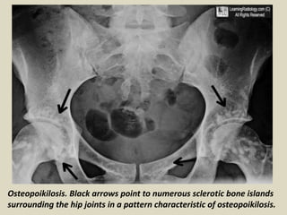 Presentation1, radiological imaging of ostepopikilosis | PPTX