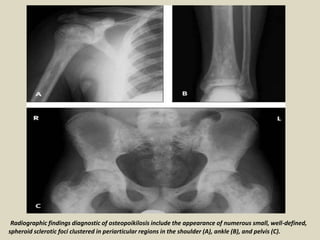 Presentation1, radiological imaging of ostepopikilosis | PPTX