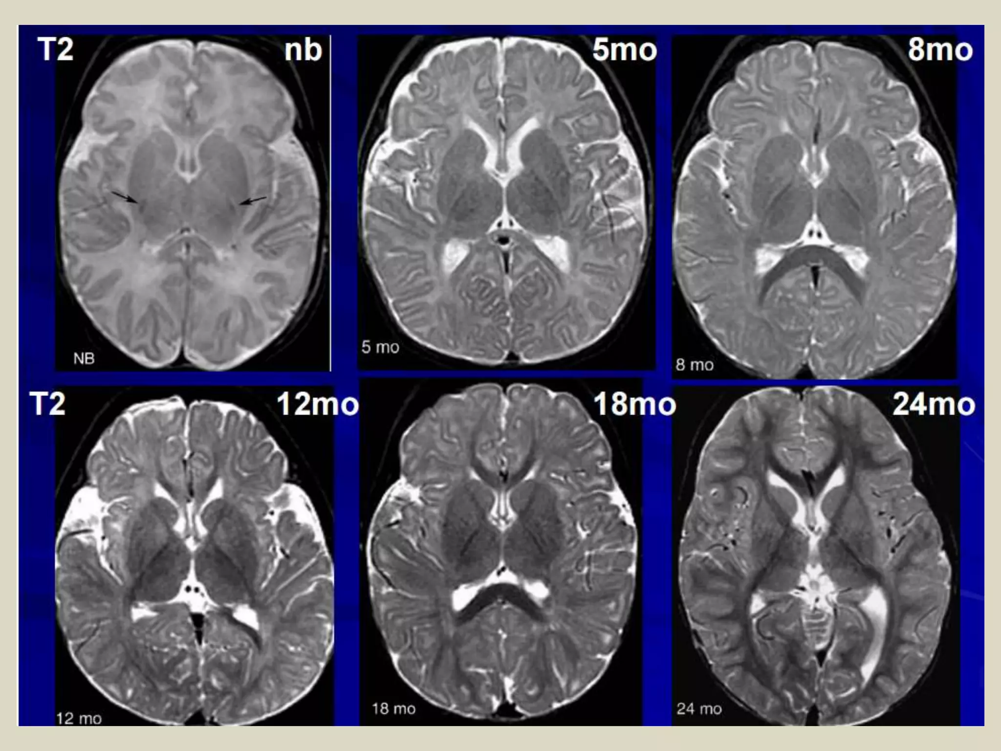 Presentation1, radiological imaging of pediatric leukodystrophy. | PPTX