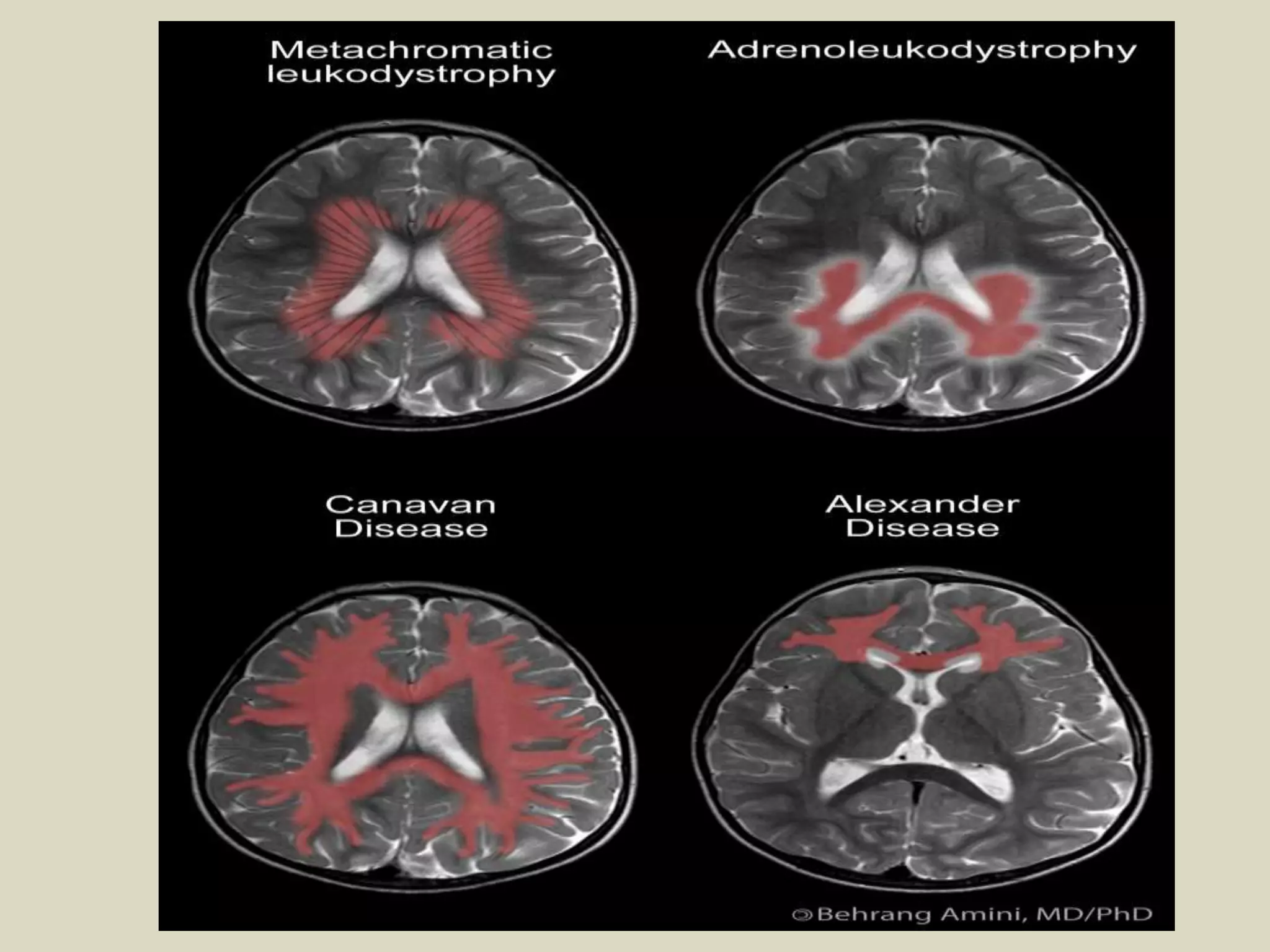 Presentation1, radiological imaging of pediatric leukodystrophy. | PPTX