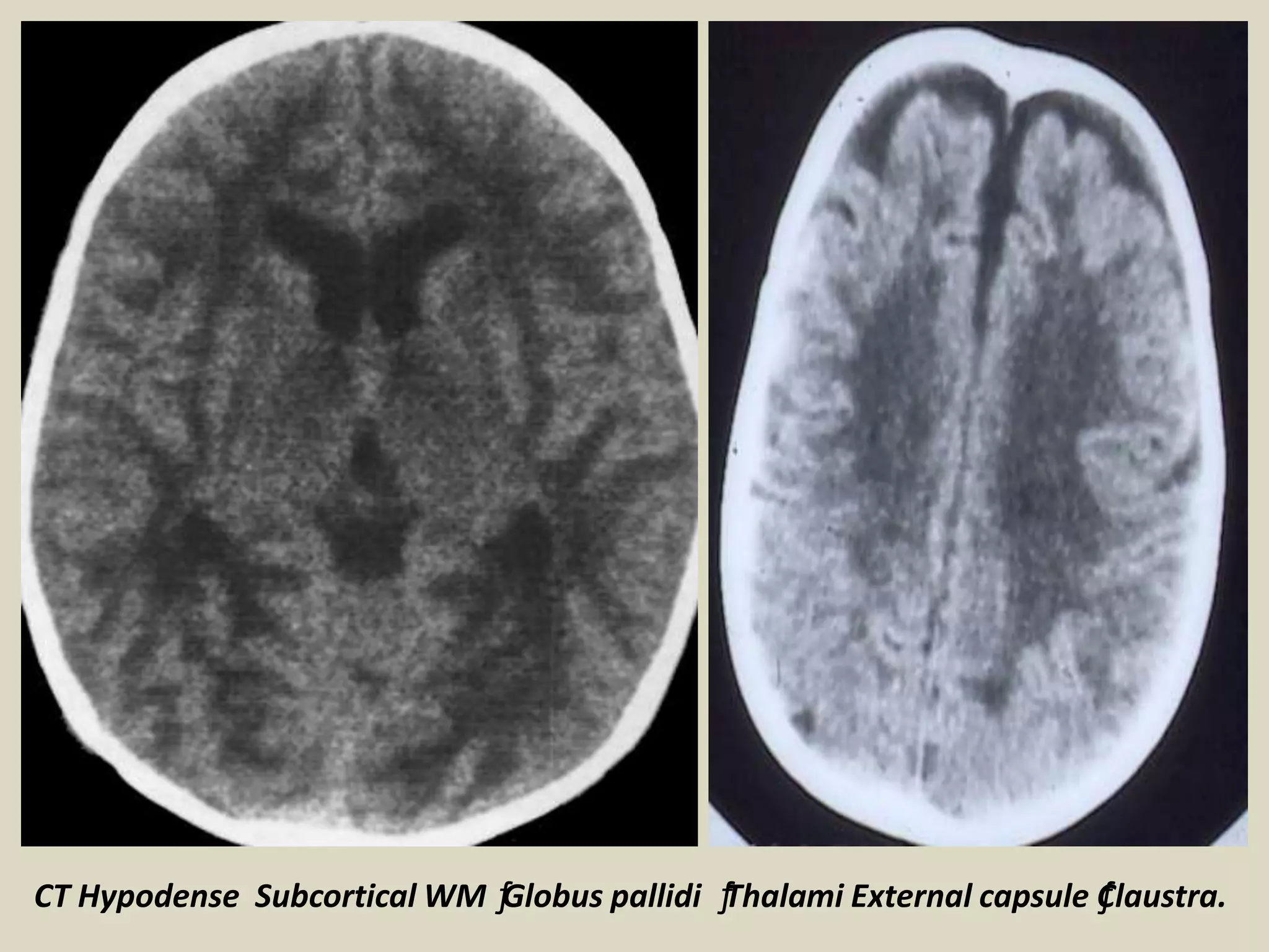 Presentation1, radiological imaging of pediatric leukodystrophy. | PPTX