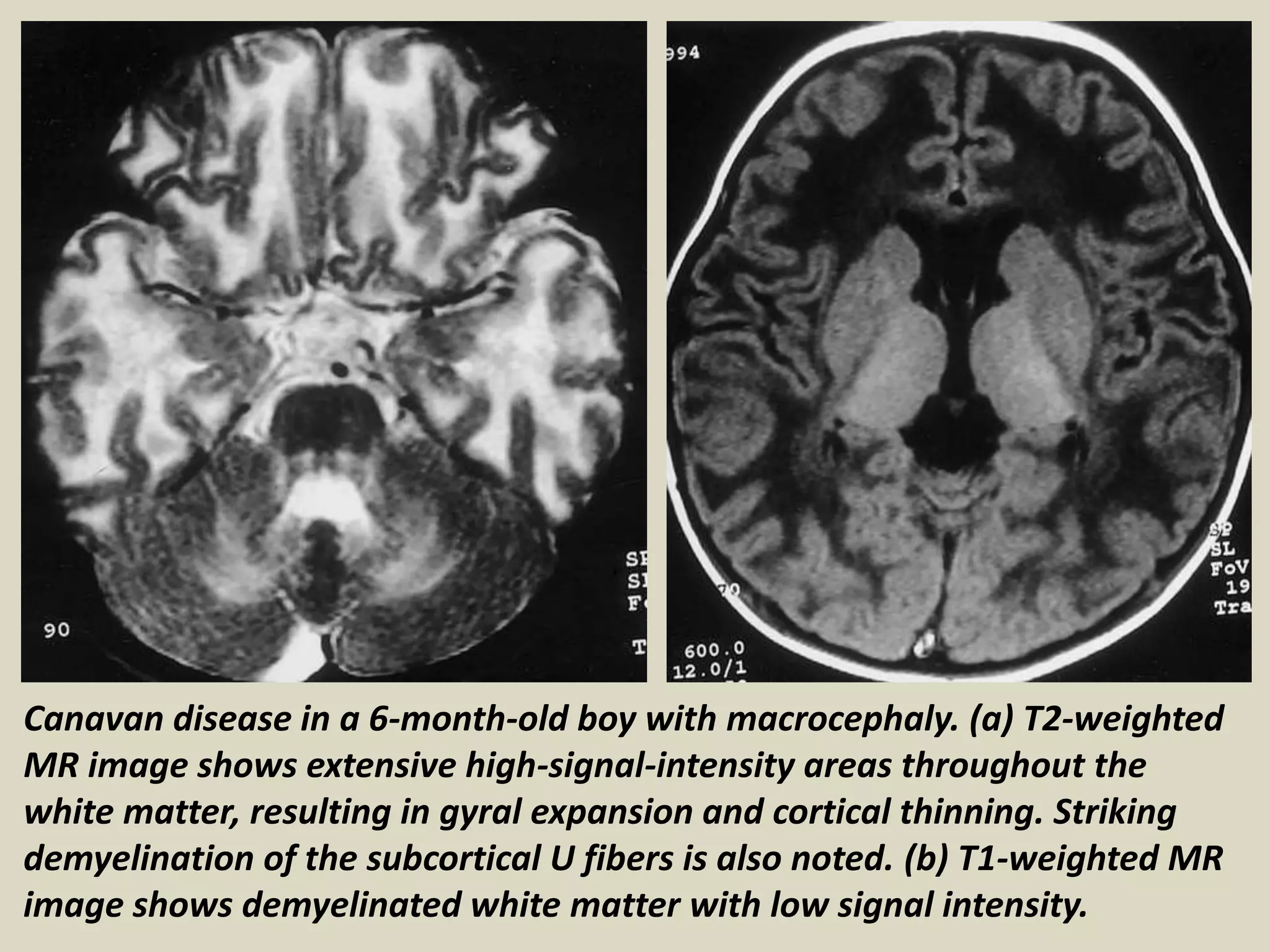 Presentation1, radiological imaging of pediatric leukodystrophy. | PPTX