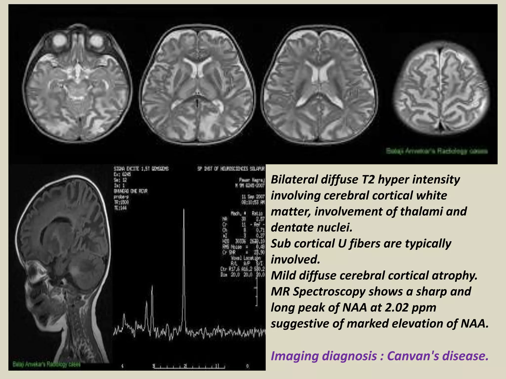 Presentation1, radiological imaging of pediatric leukodystrophy. | PPTX
