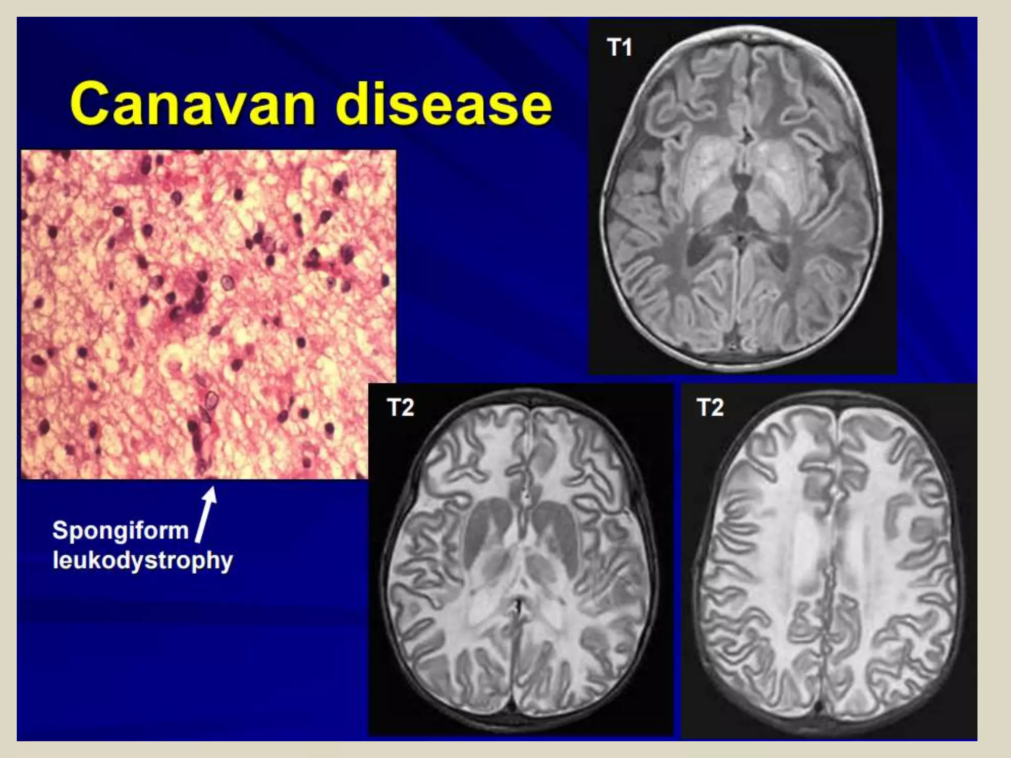 Presentation1, radiological imaging of pediatric leukodystrophy. | PPTX