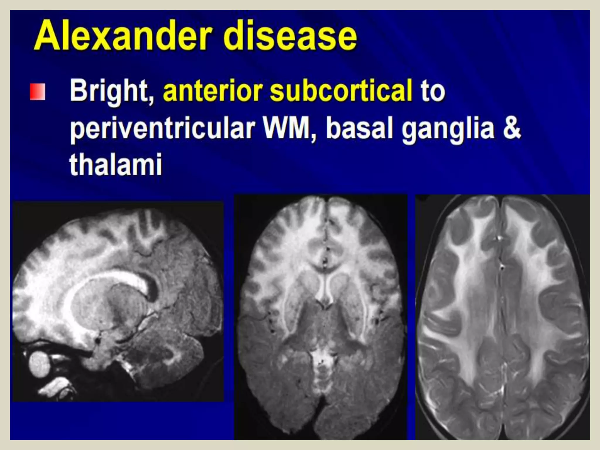 Presentation1, radiological imaging of pediatric leukodystrophy. | PPTX