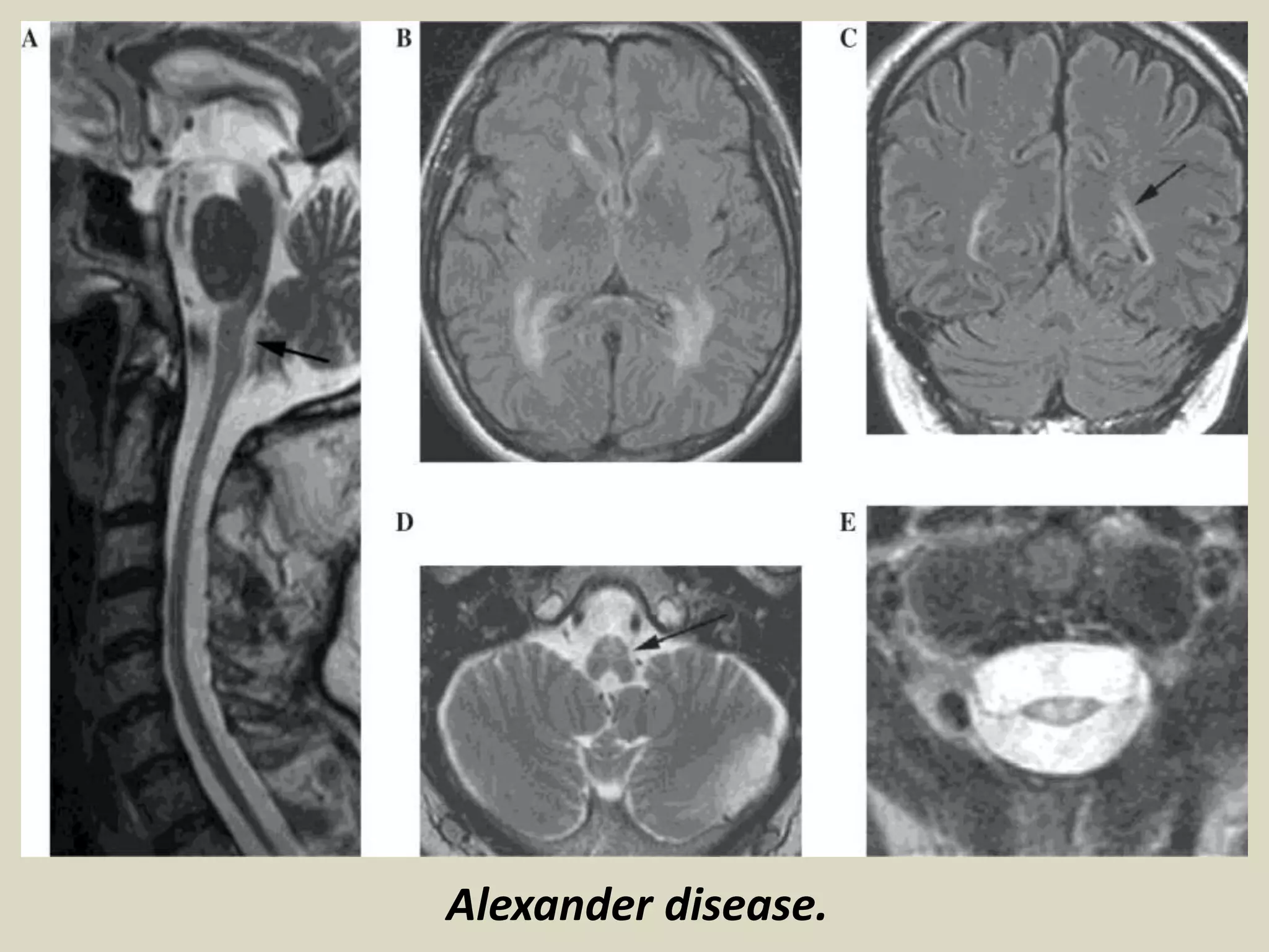 Presentation1, radiological imaging of pediatric leukodystrophy. | PPTX