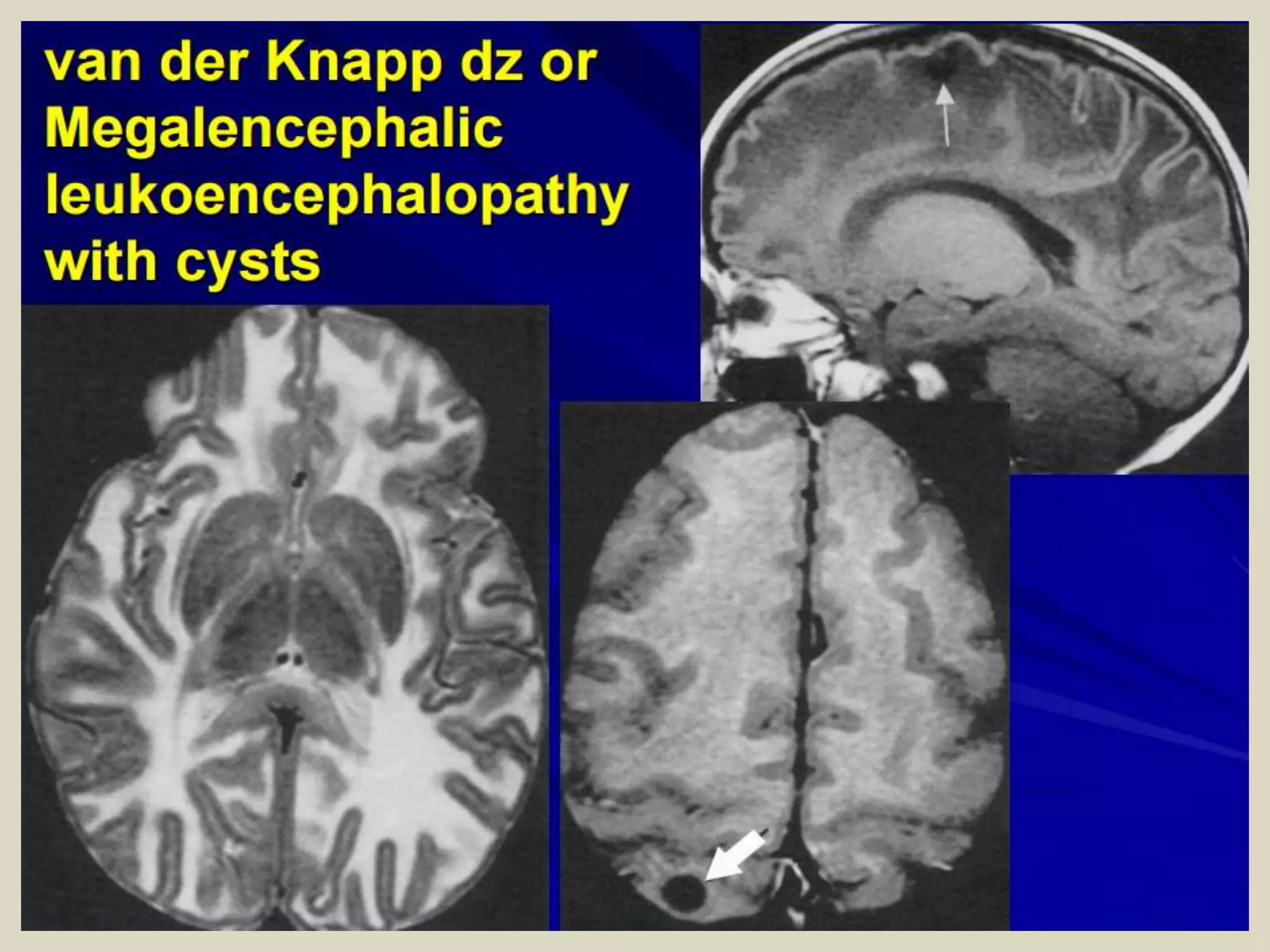 Presentation1, radiological imaging of pediatric leukodystrophy. | PPTX