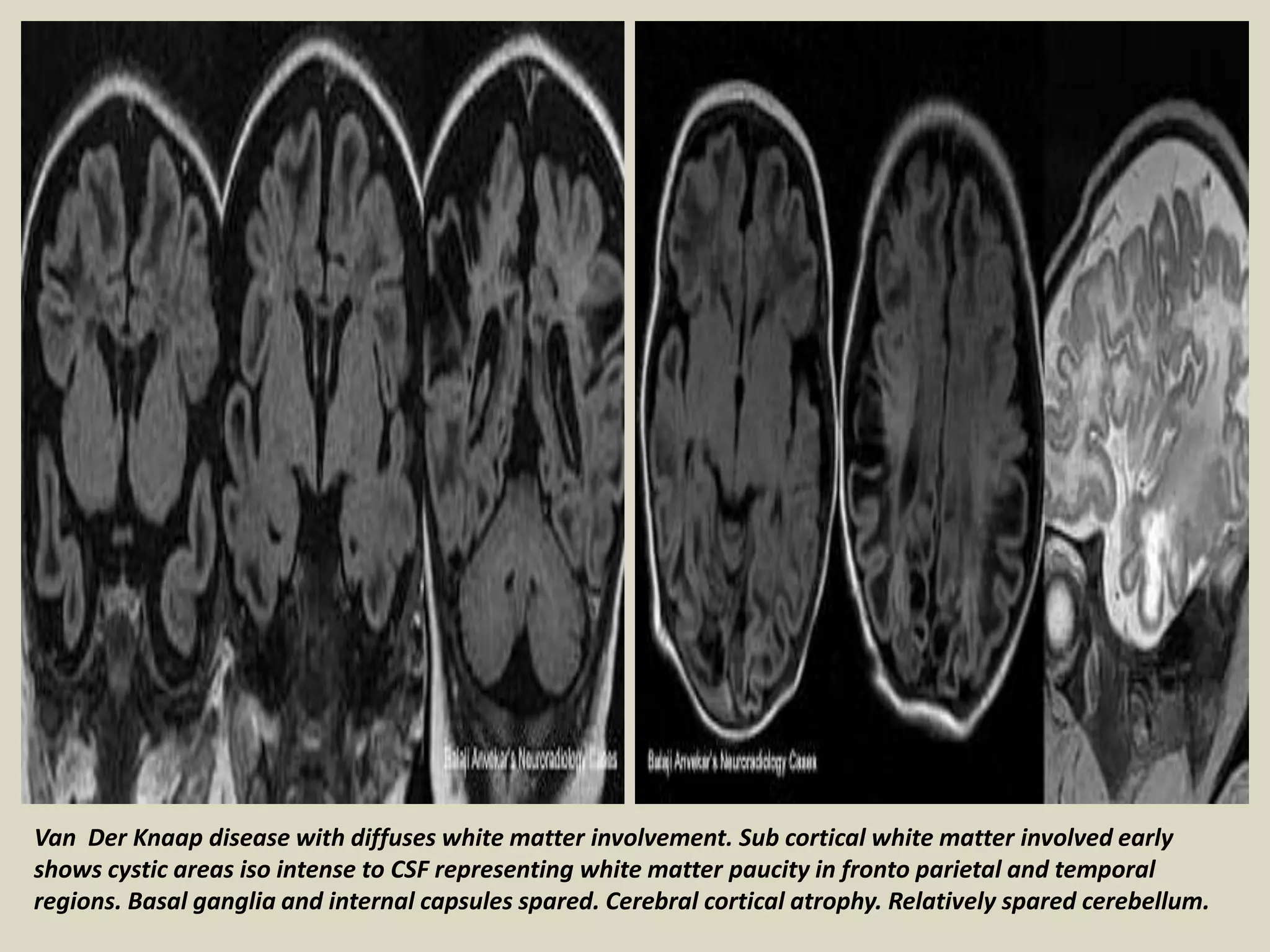 Presentation1, radiological imaging of pediatric leukodystrophy. | PPTX