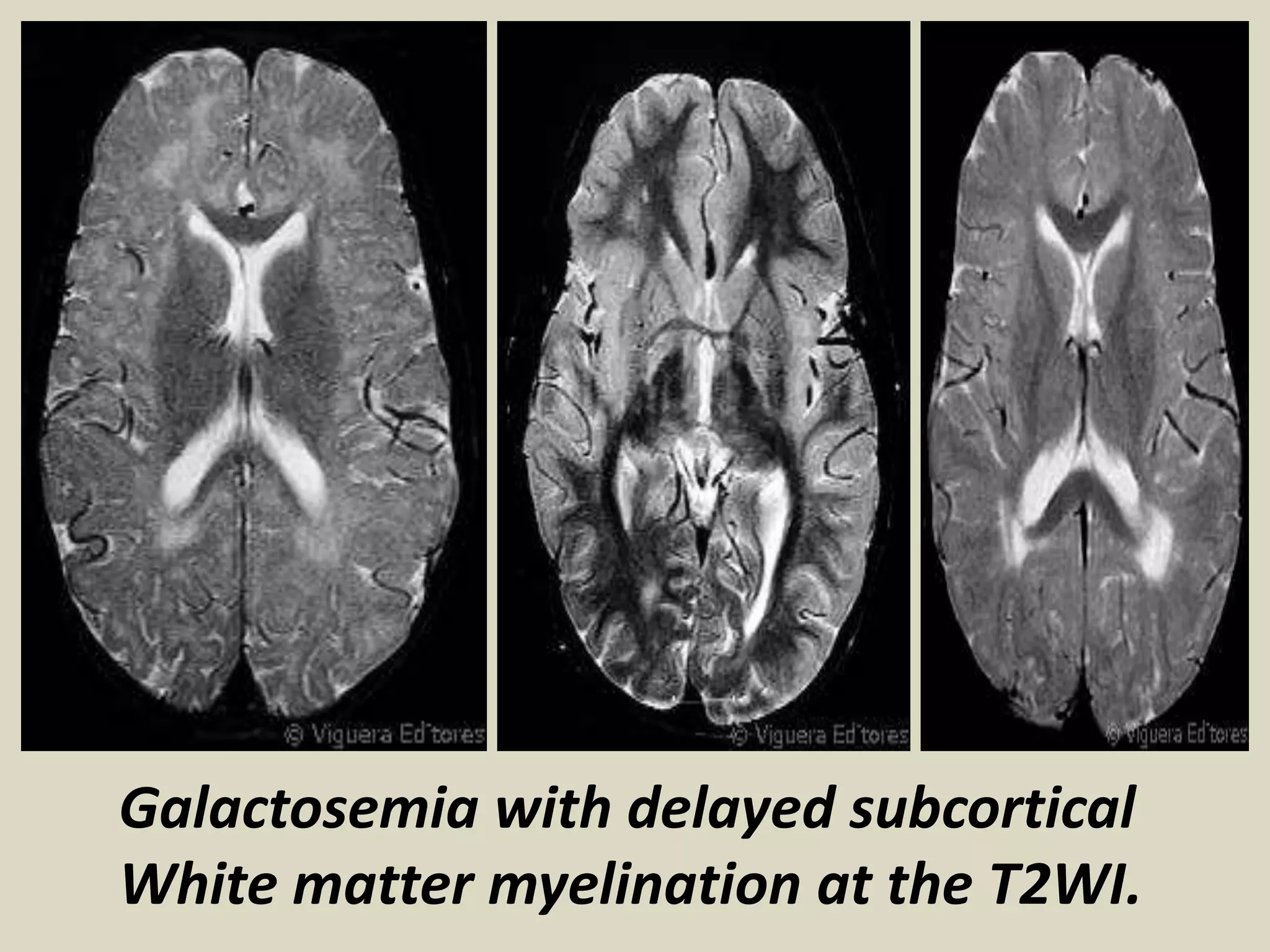 Presentation1, radiological imaging of pediatric leukodystrophy. | PPTX