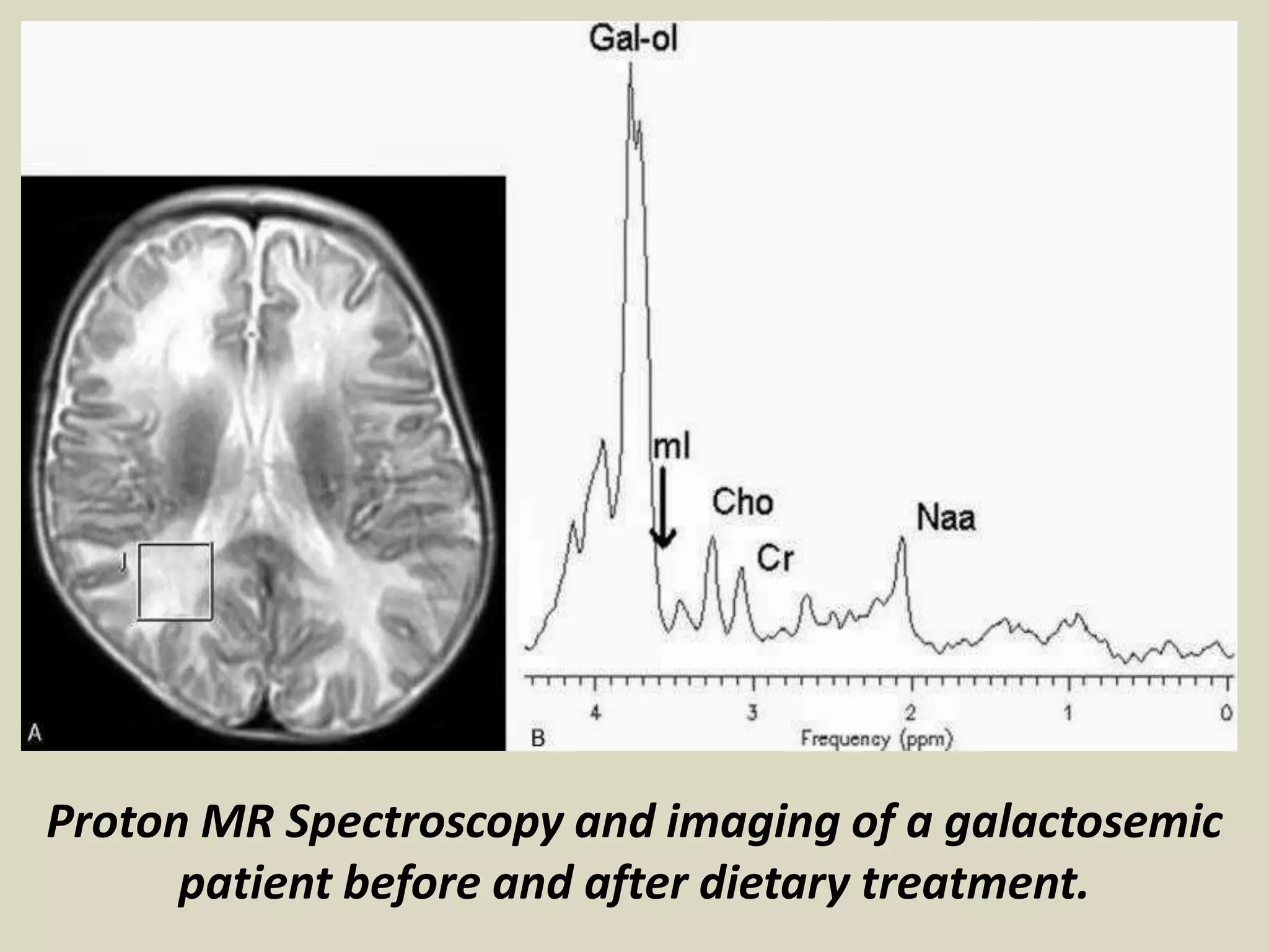 Presentation1, radiological imaging of pediatric leukodystrophy. | PPTX