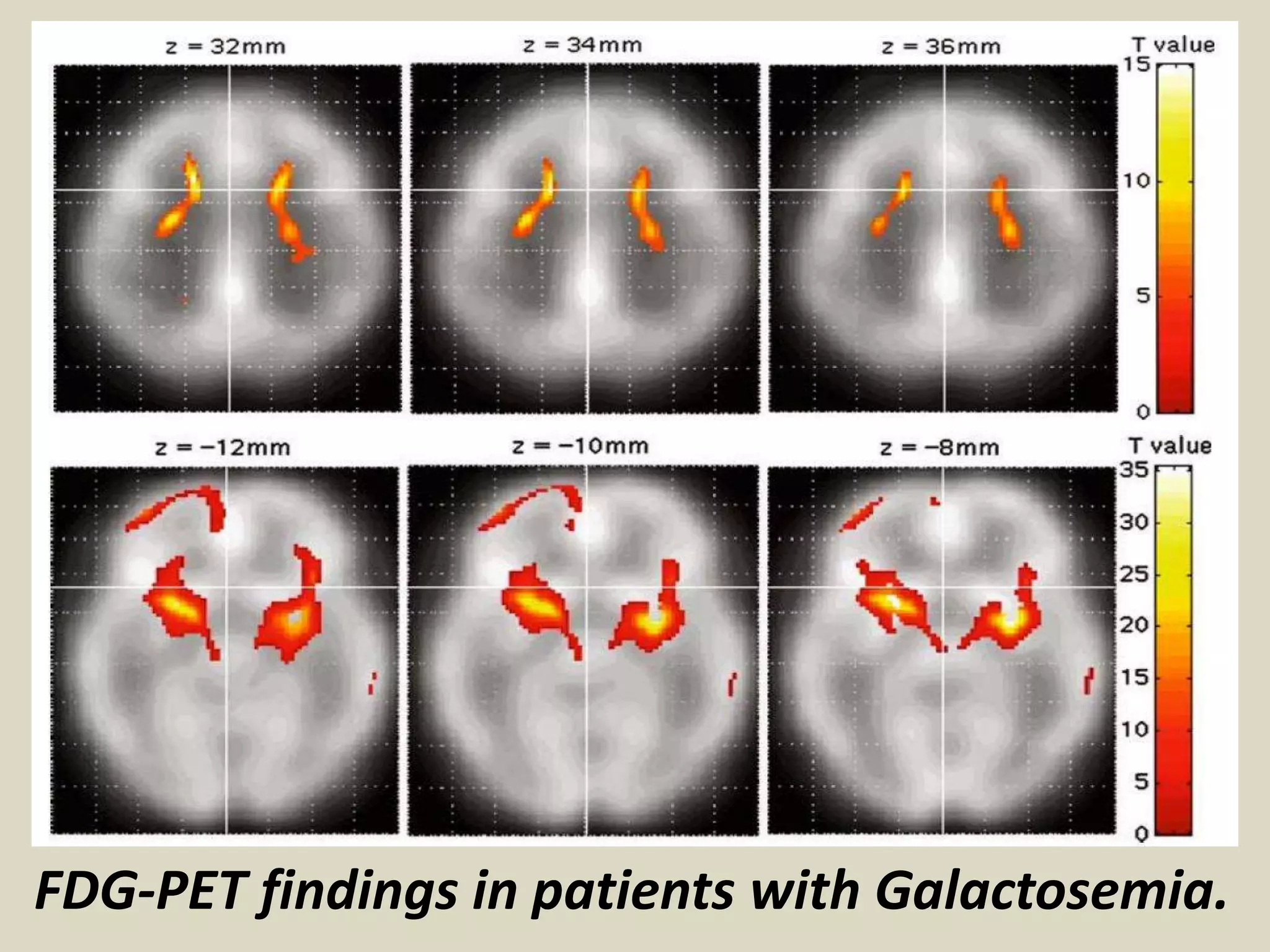 Presentation1, radiological imaging of pediatric leukodystrophy. | PPTX