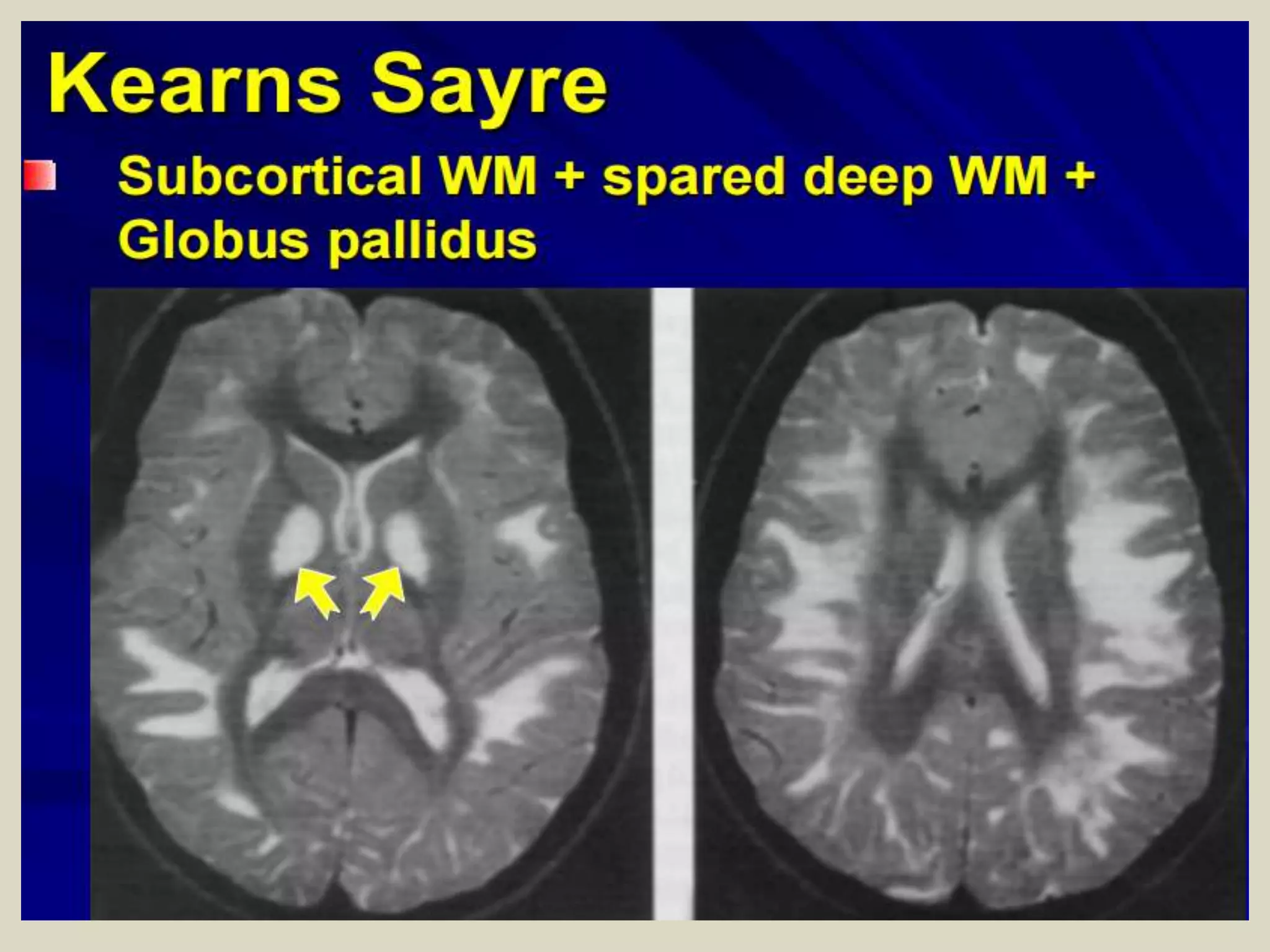 Presentation1, radiological imaging of pediatric leukodystrophy. | PPTX