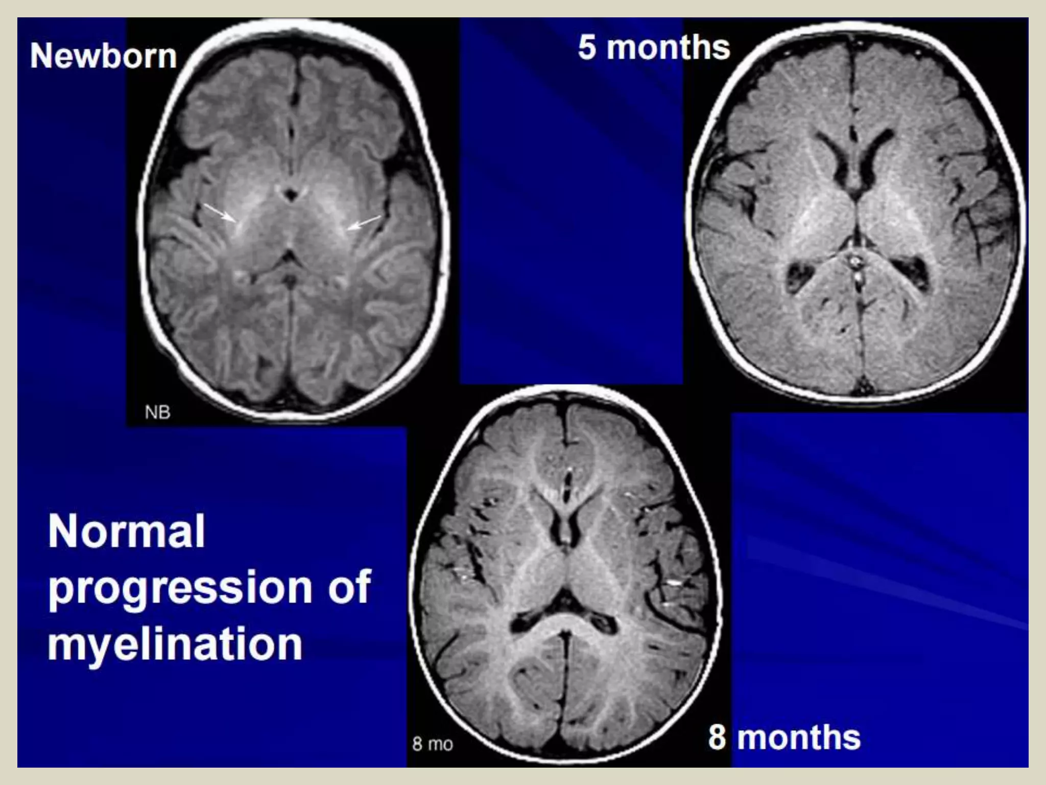 Presentation1, radiological imaging of pediatric leukodystrophy. | PPTX