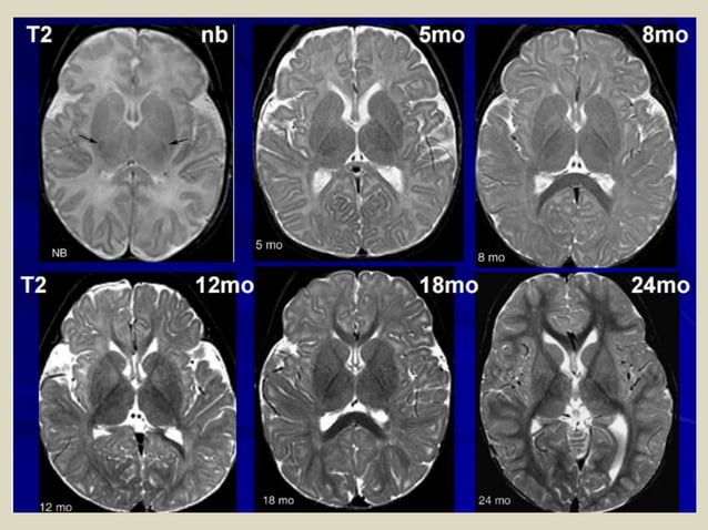 Presentation1, radiological imaging of pediatric leukodystrophy. | PPTX