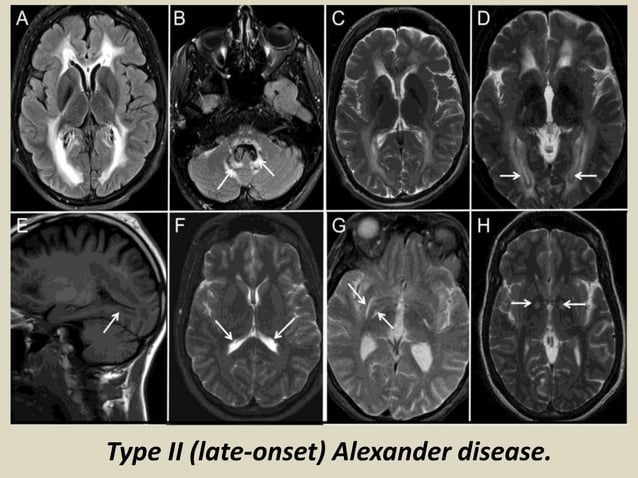 Presentation1, radiological imaging of pediatric leukodystrophy. | PPTX