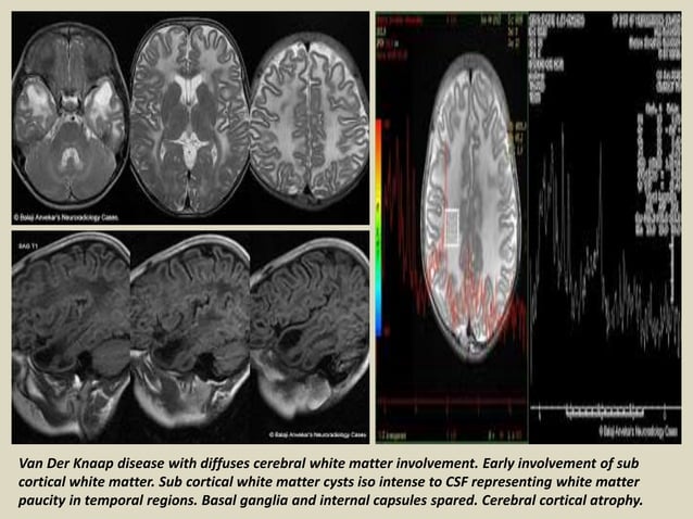 Presentation1, radiological imaging of pediatric leukodystrophy. | PPTX