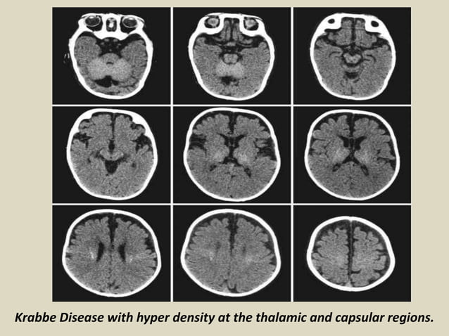 Presentation1, radiological imaging of pediatric leukodystrophy. | PPTX