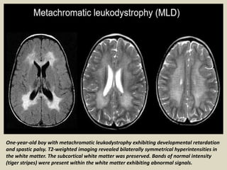 Presentation1, radiological imaging of pediatric leukodystrophy. | PPTX