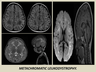 Presentation1, radiological imaging of pediatric leukodystrophy. | PPTX