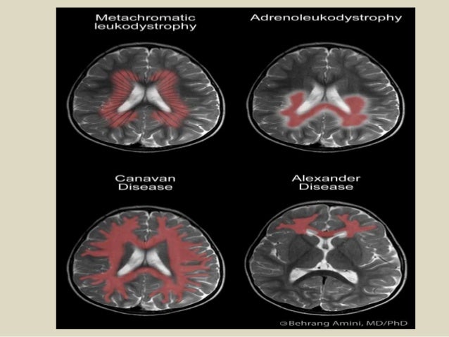Presentation1, radiological imaging of pediatric leukodystrophy.