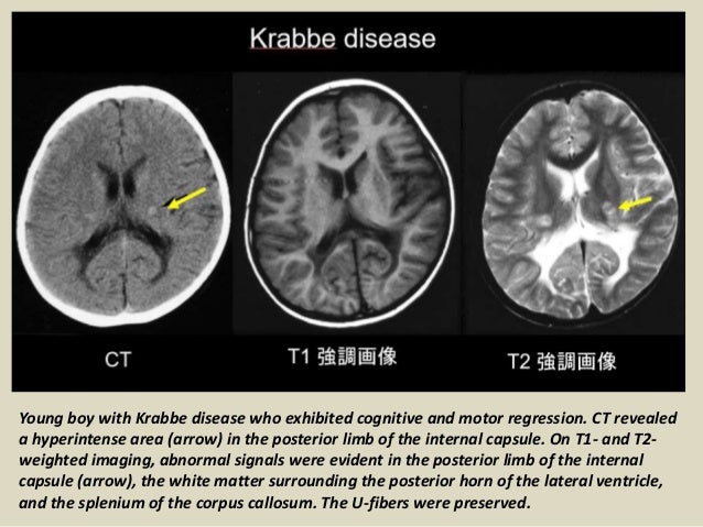 Presentation1, radiological imaging of pediatric leukodystrophy.