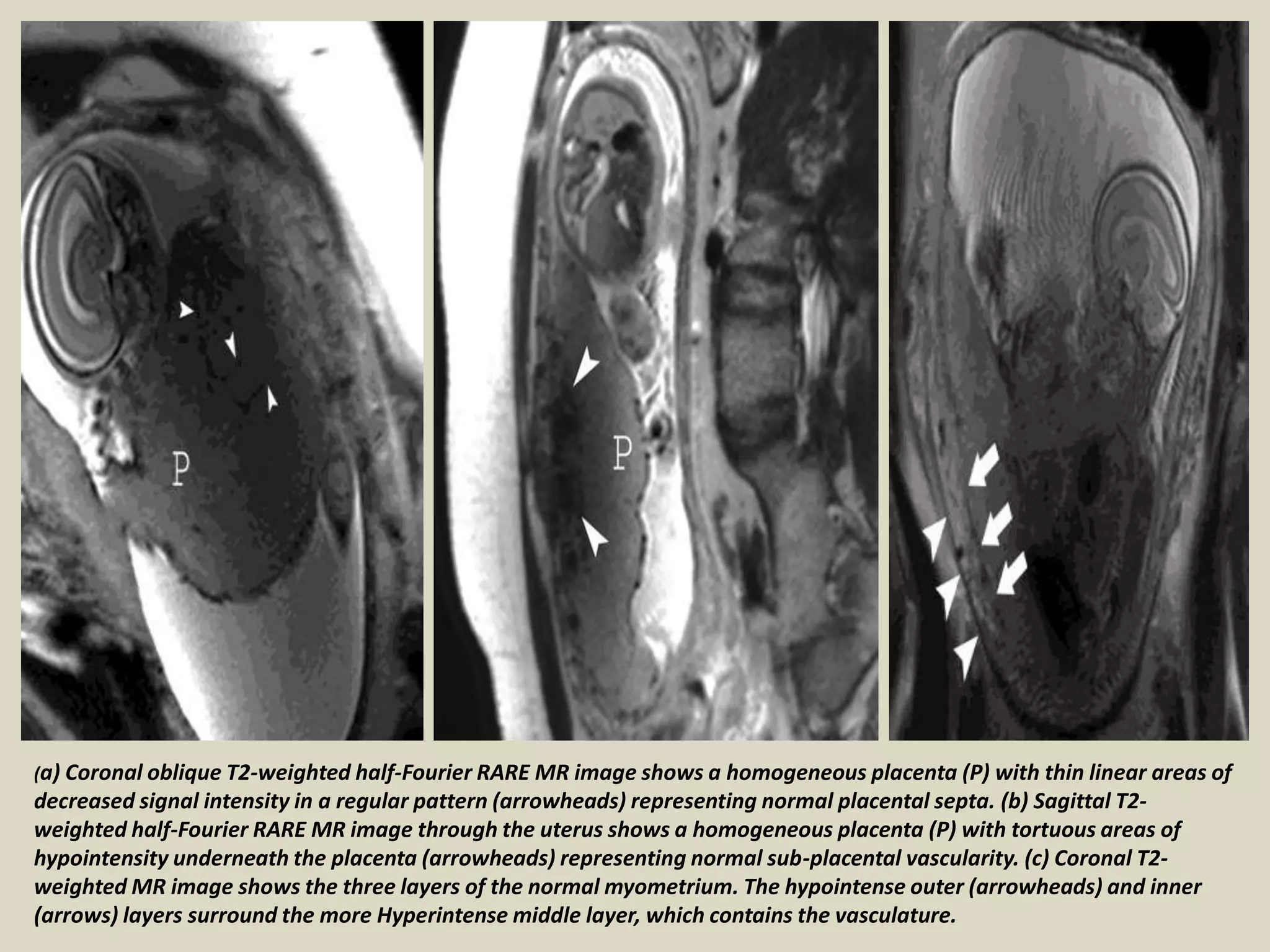Presentation1, radiological imaging of placenta accreta. | PPTX