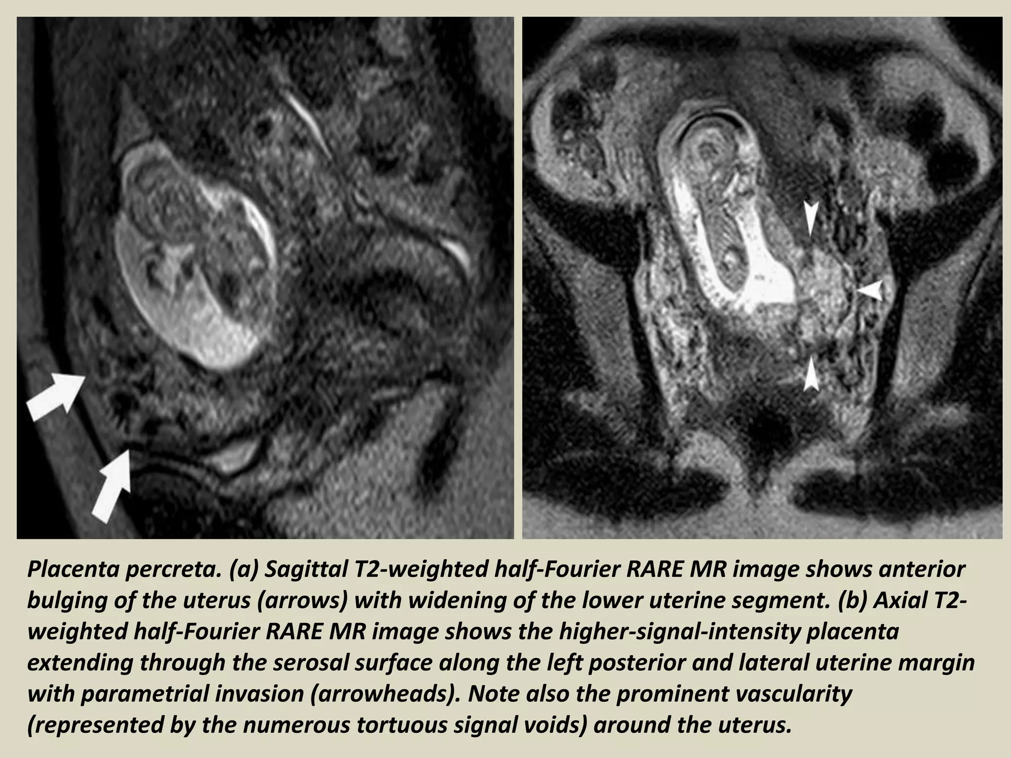Presentation1, radiological imaging of placenta accreta. | PPTX