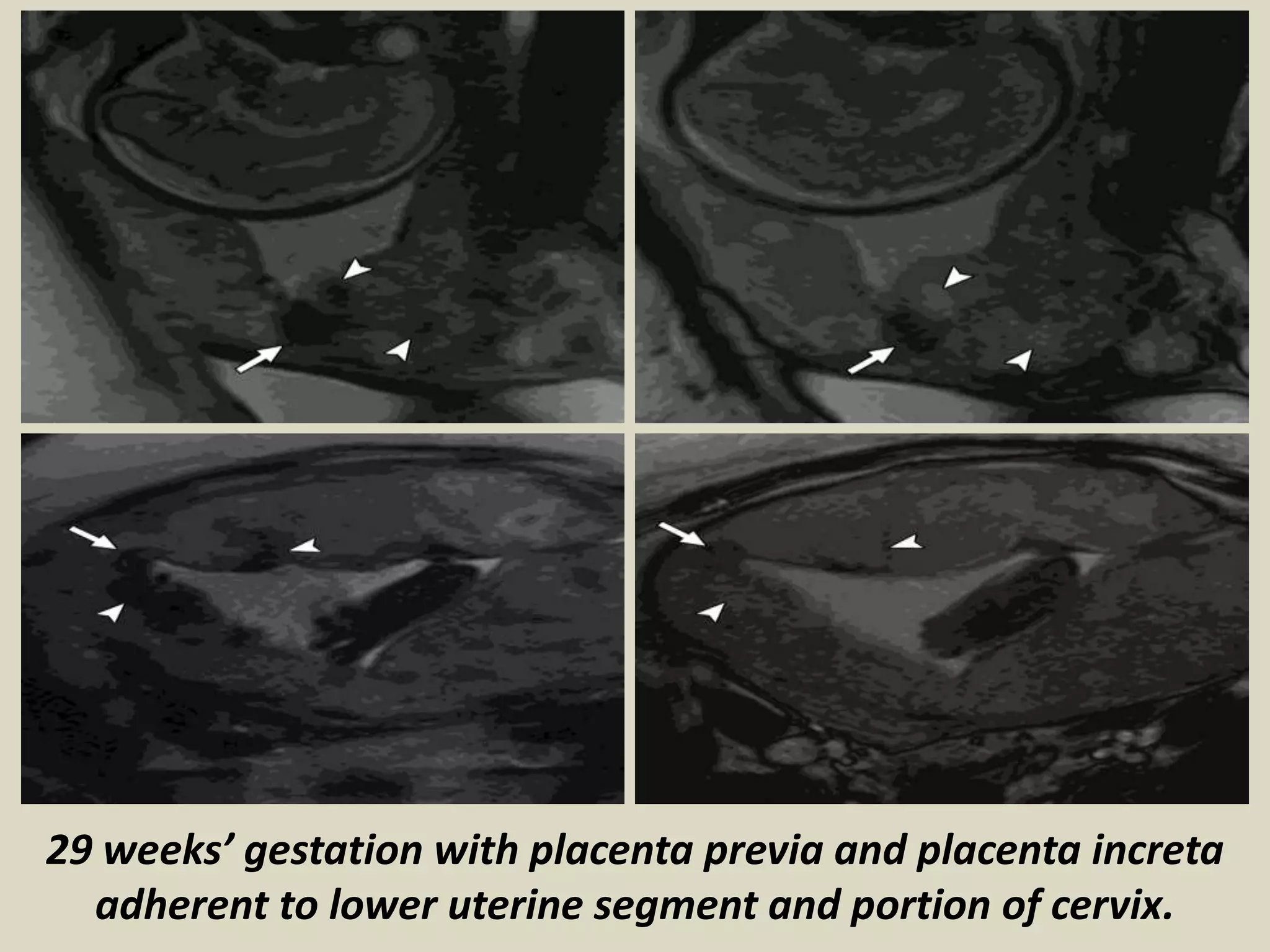 Presentation1, radiological imaging of placenta accreta. | PPTX