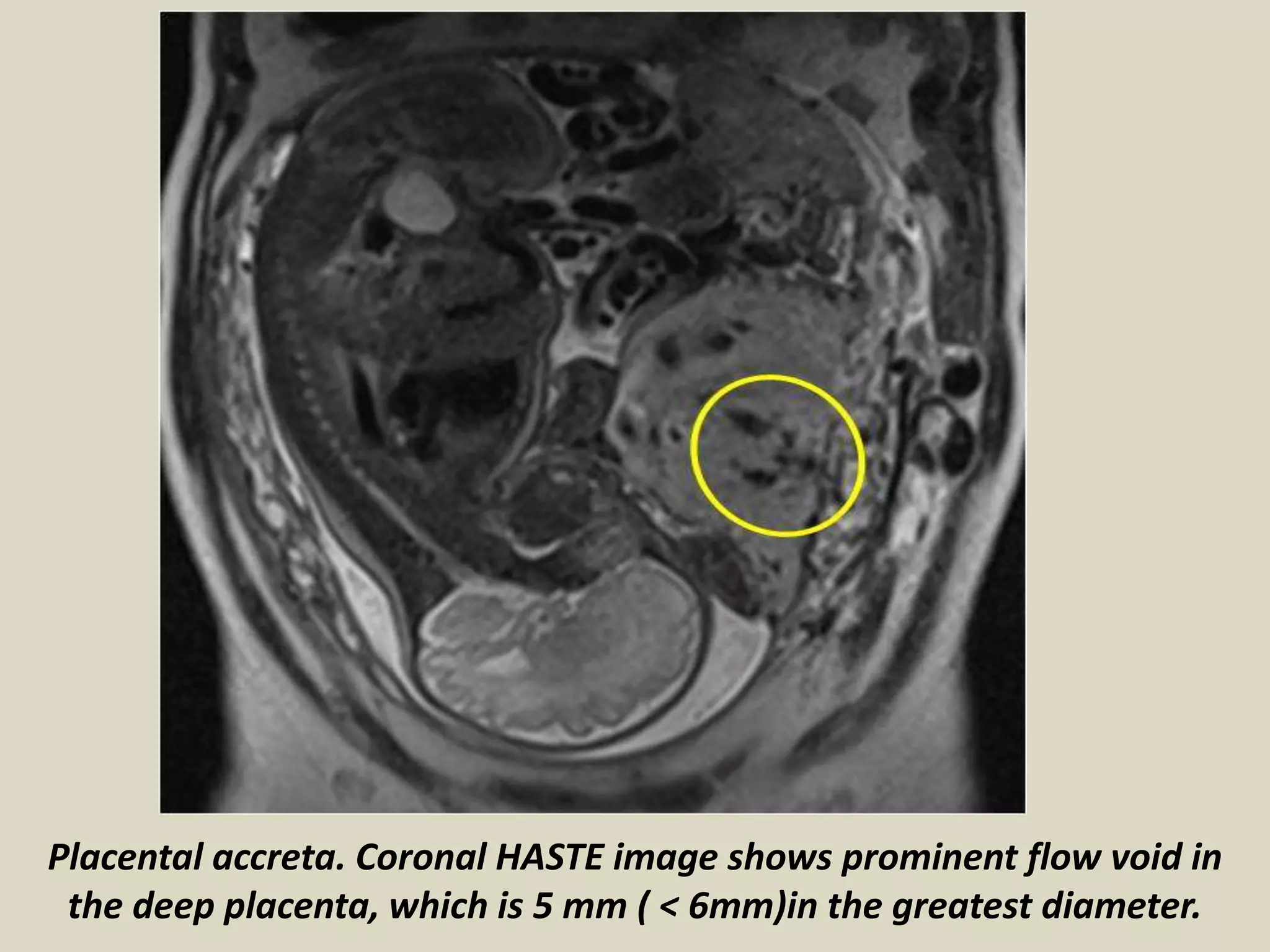 Presentation1, radiological imaging of placenta accreta. | PPT