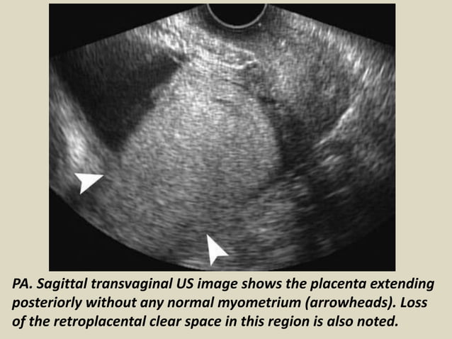 Presentation1, radiological imaging of placenta accreta. | PPTX ...