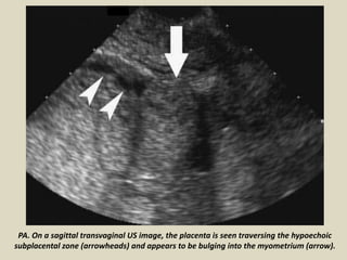 Placenta Percreta Ultrasound