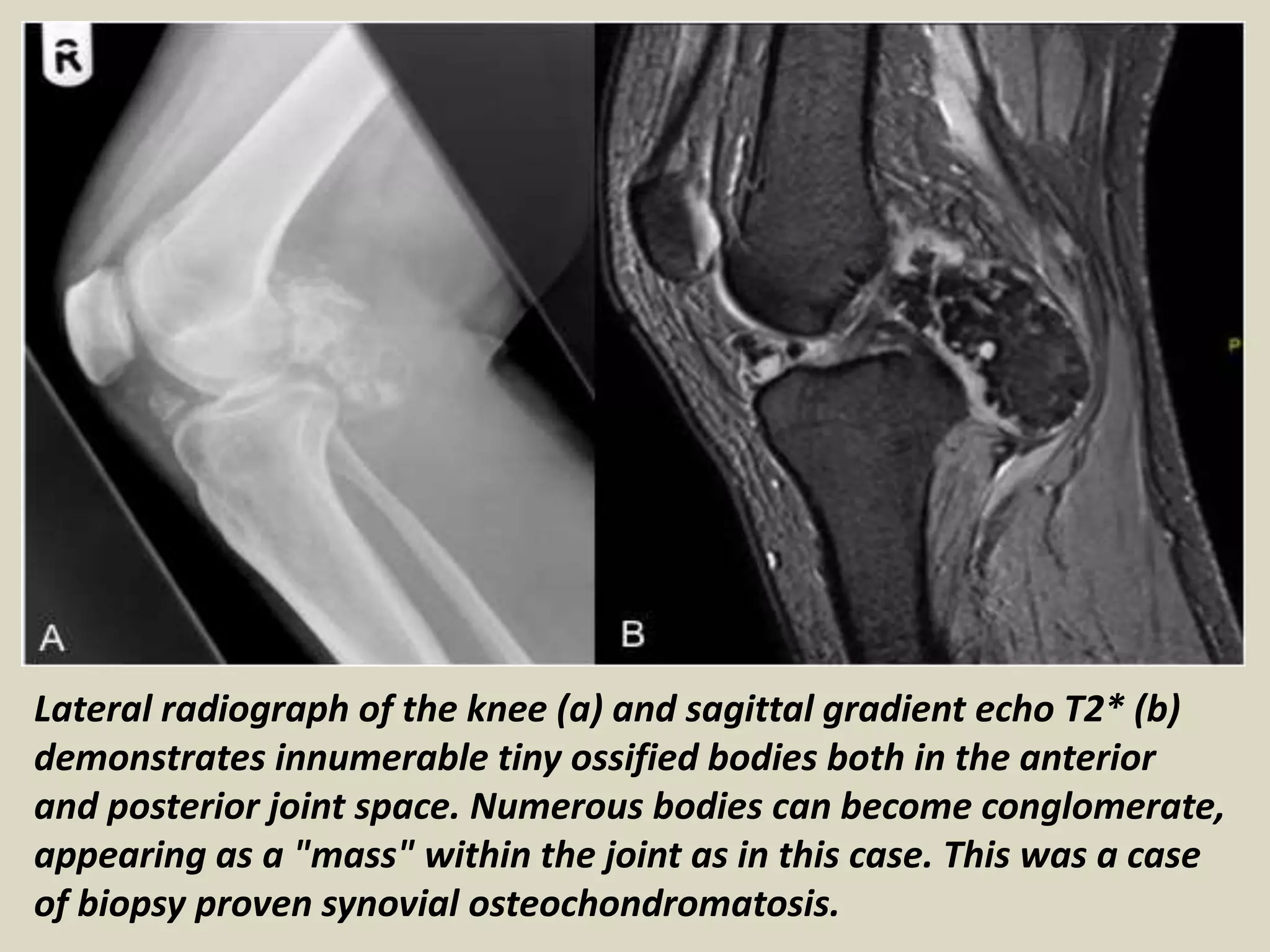 Presentation1, radiological imaging of popliteal fossa masses. | PPTX