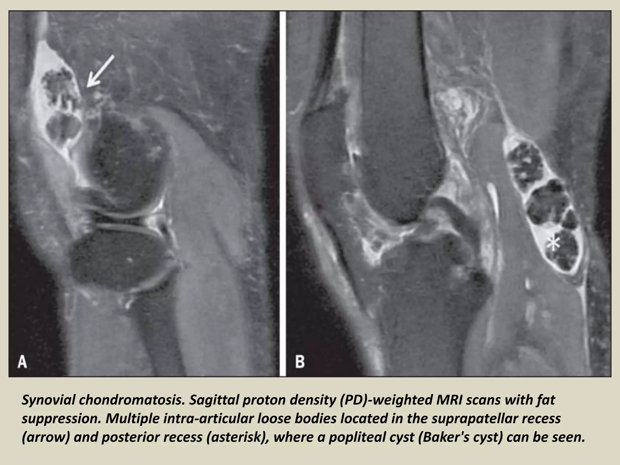 Presentation1, radiological imaging of popliteal fossa masses. | PPTX