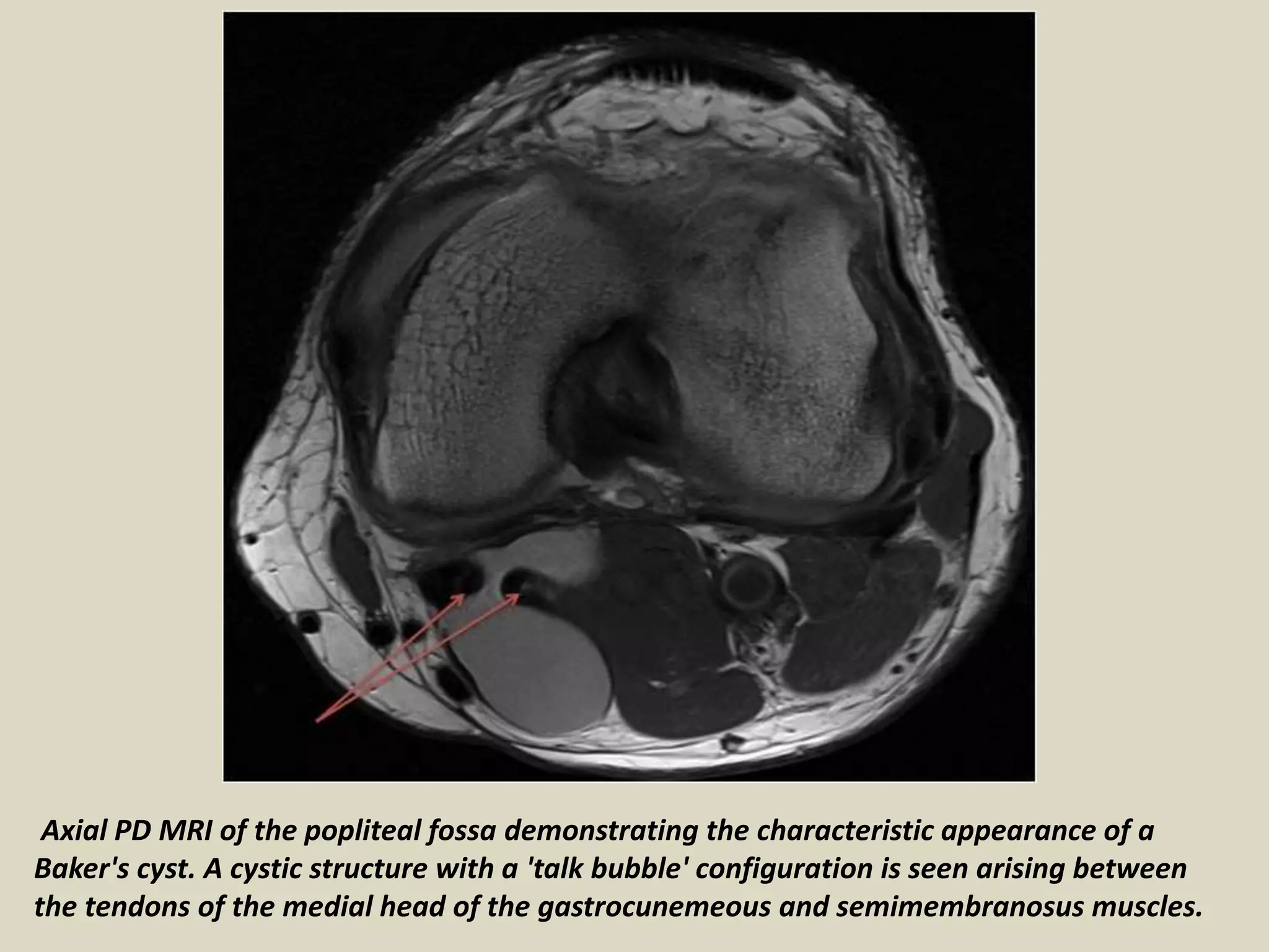 Presentation1, radiological imaging of popliteal fossa masses. | PPTX