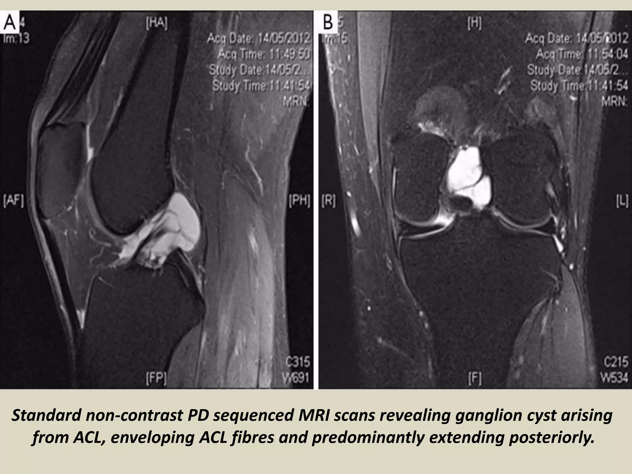 Presentation1, radiological imaging of popliteal fossa masses. | PPTX