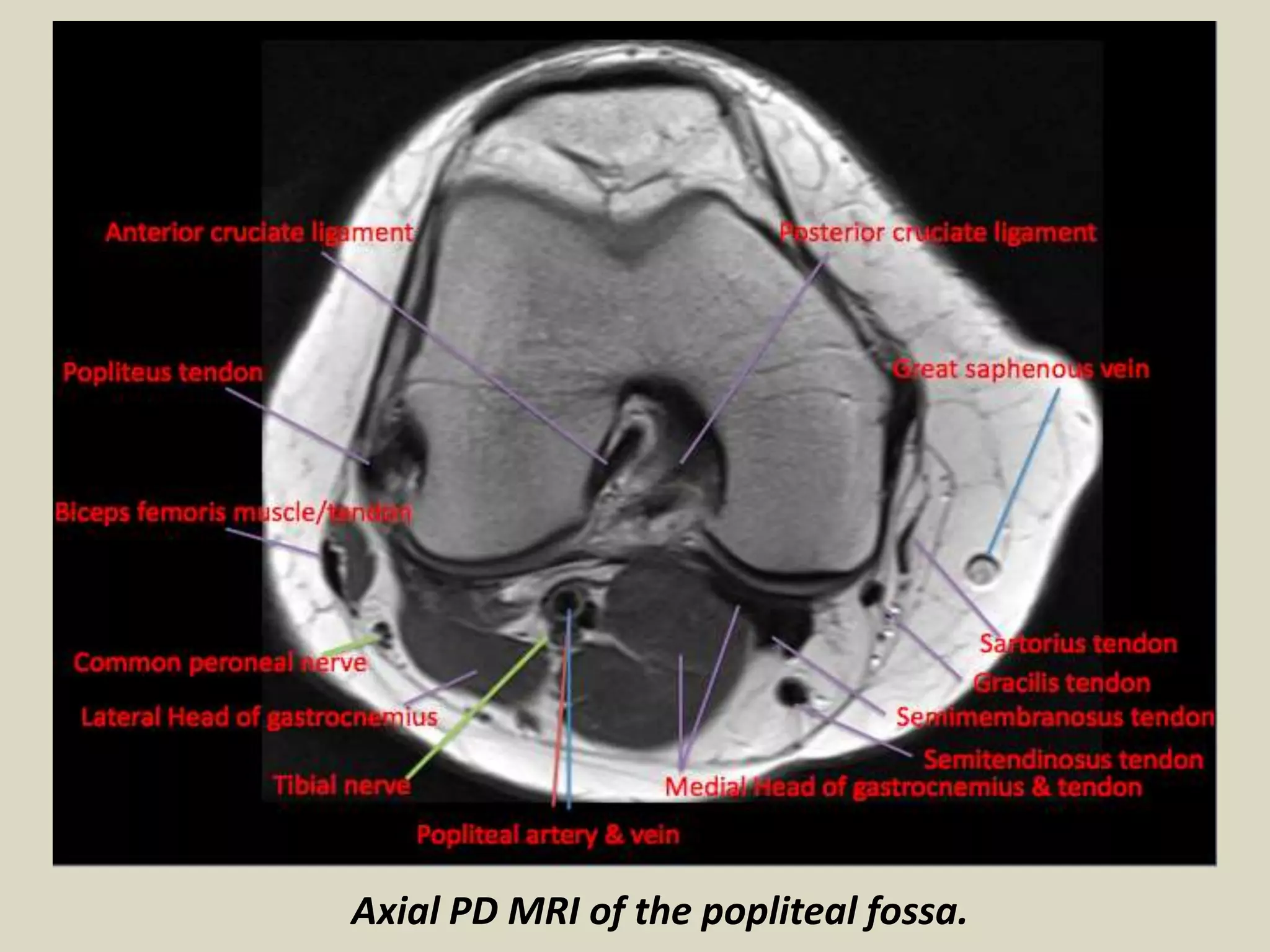 Presentation1, radiological imaging of popliteal fossa masses. | PPTX