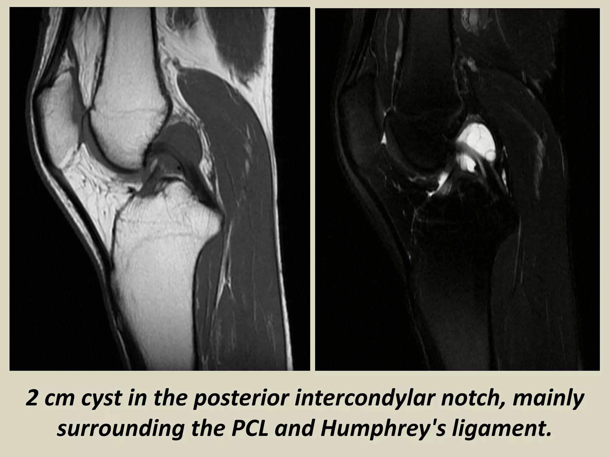 Presentation1, radiological imaging of popliteal fossa masses. | PPTX