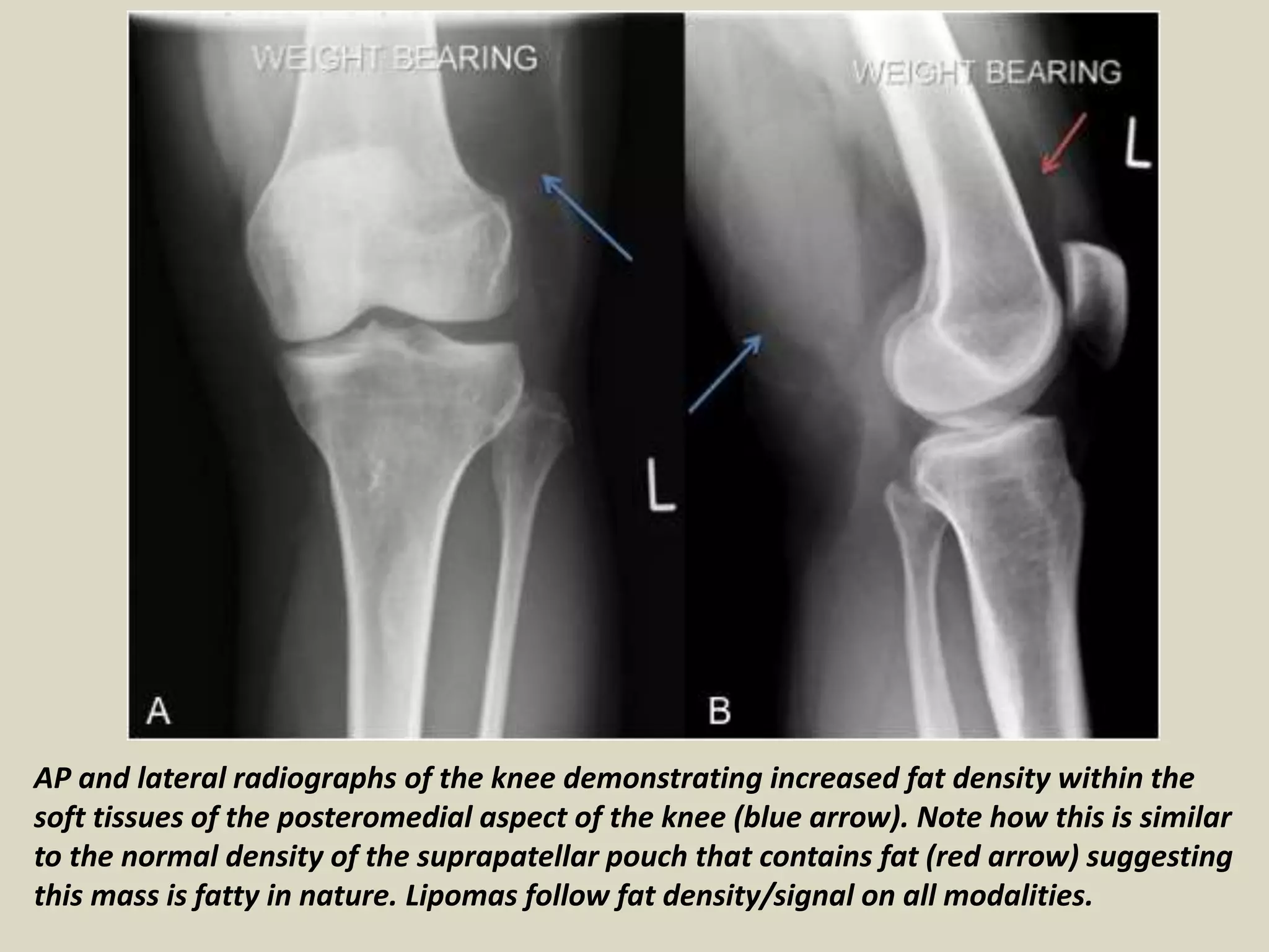 Presentation1, radiological imaging of popliteal fossa masses. | PPTX