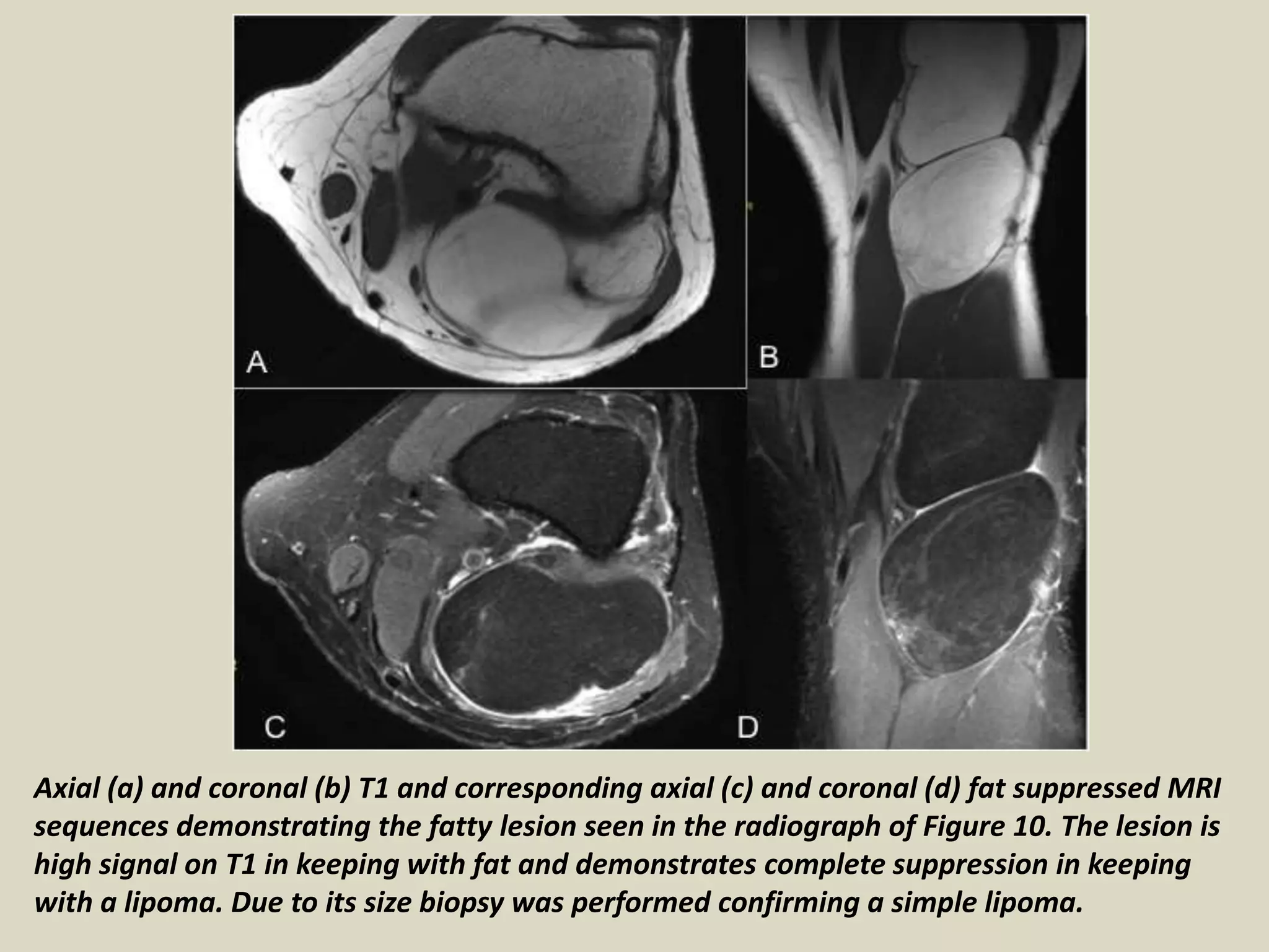 Presentation1, radiological imaging of popliteal fossa masses. | PPTX