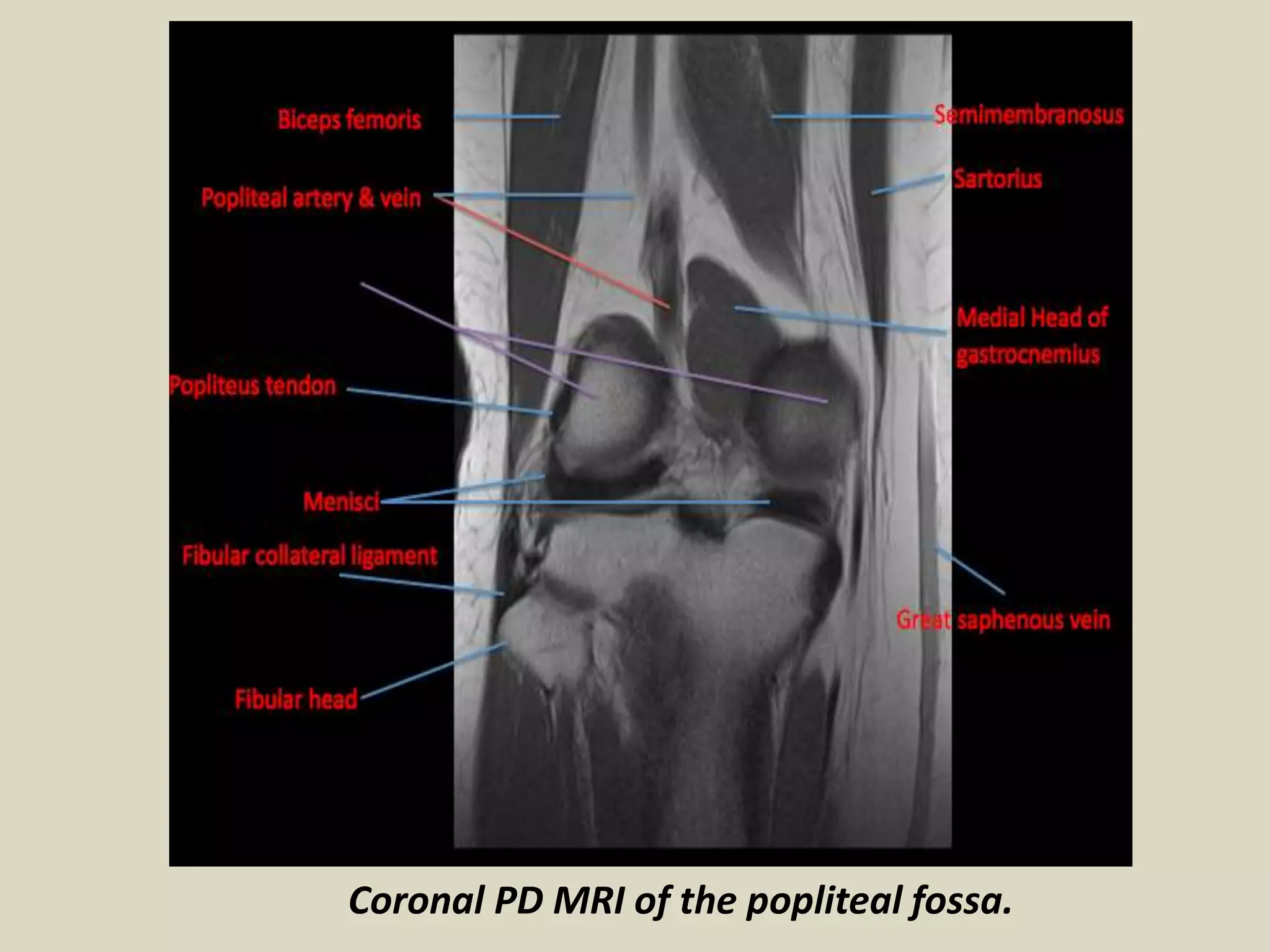 Presentation1, radiological imaging of popliteal fossa masses. | PPTX