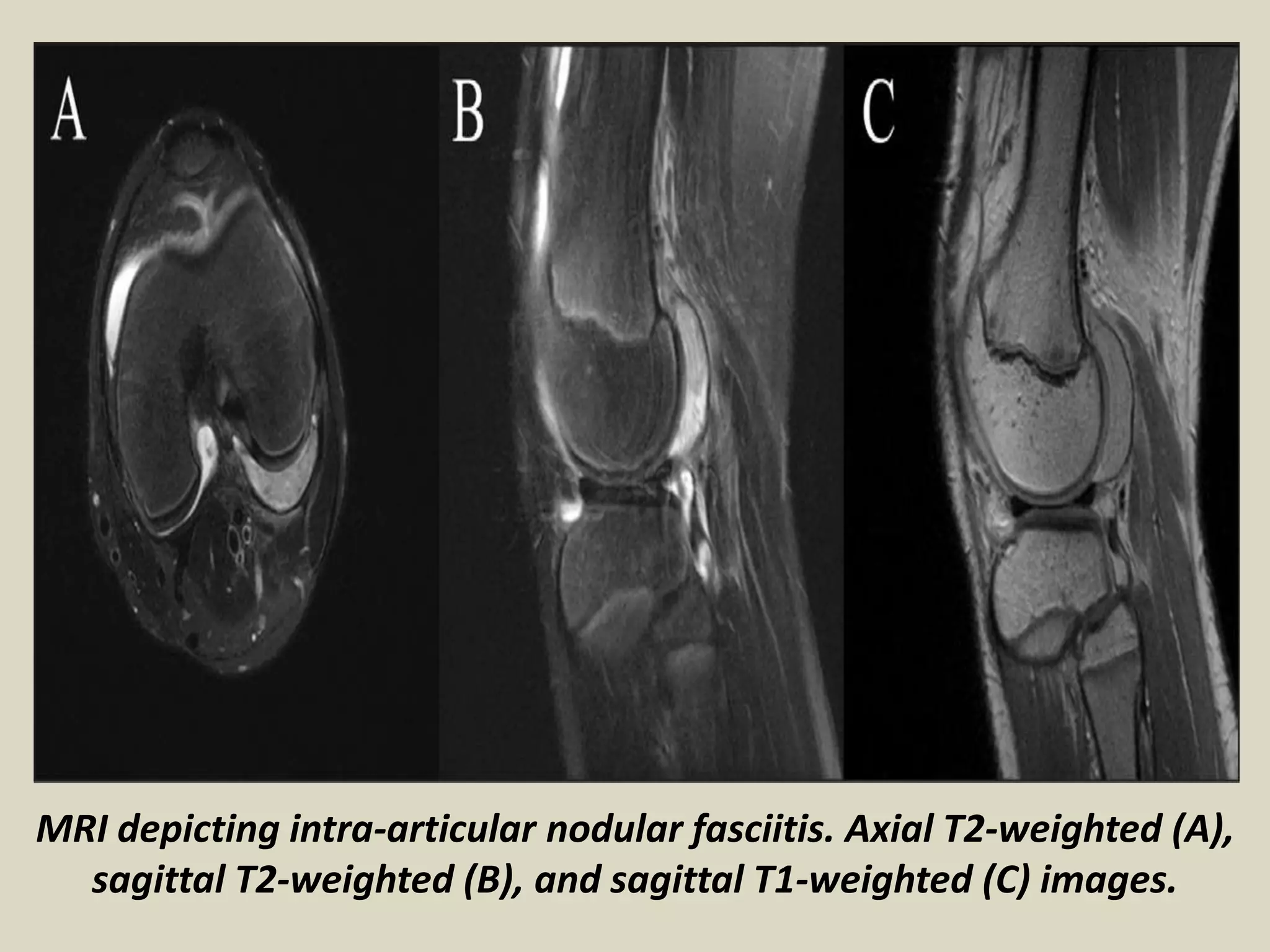 Presentation1, radiological imaging of popliteal fossa masses. | PPTX