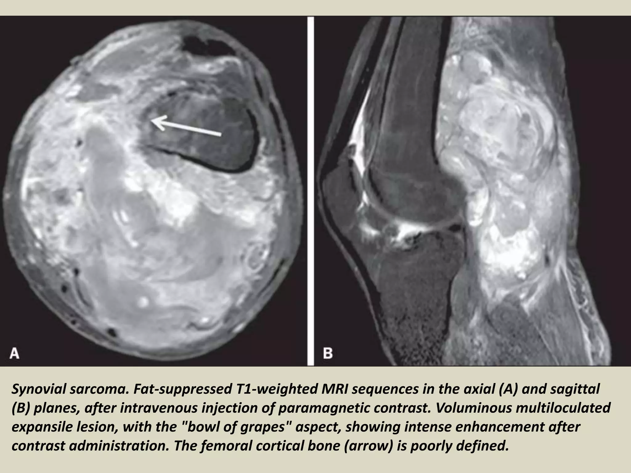 Presentation1, radiological imaging of popliteal fossa masses. | PPTX