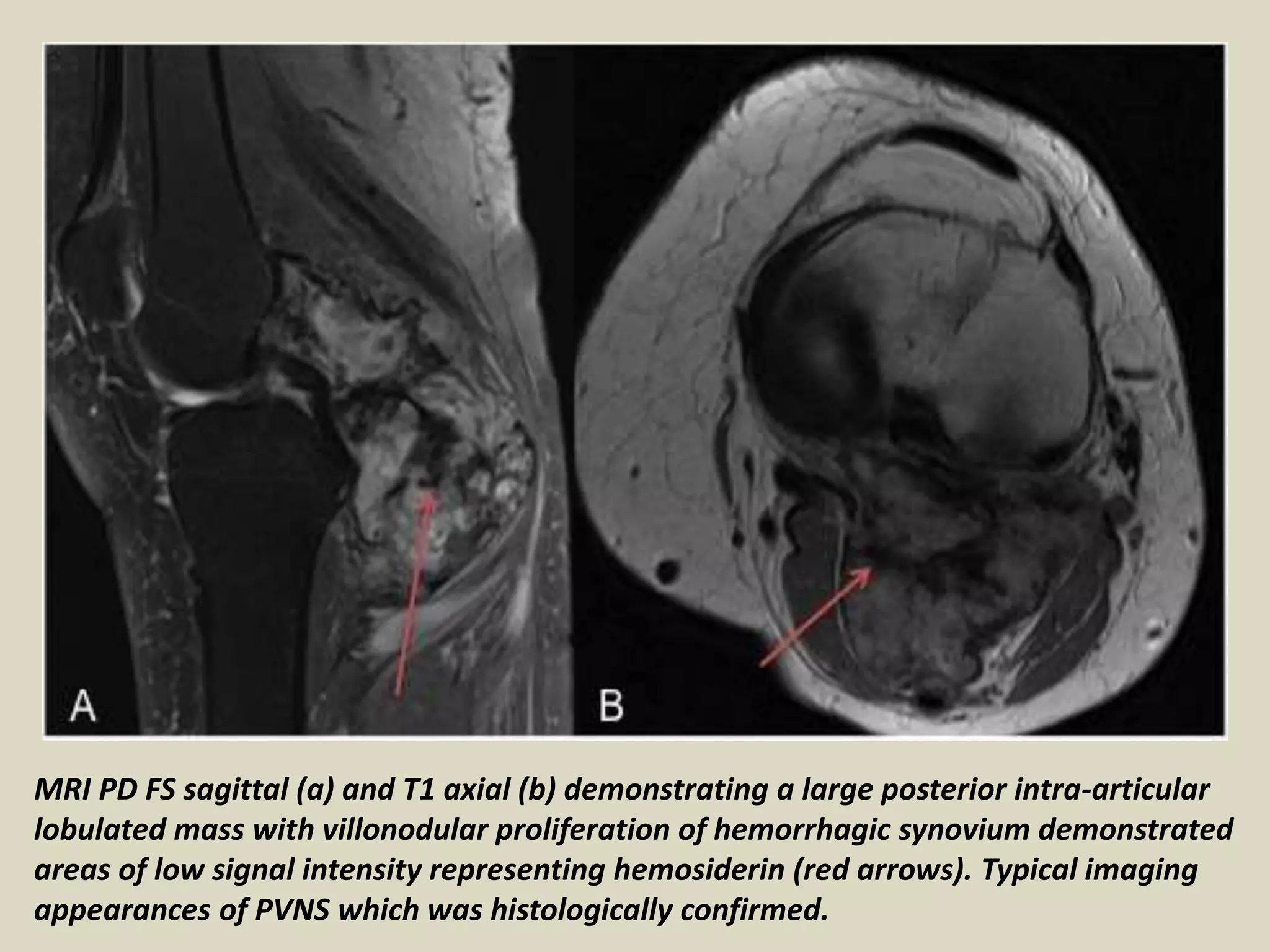 Presentation1, radiological imaging of popliteal fossa masses. | PPTX
