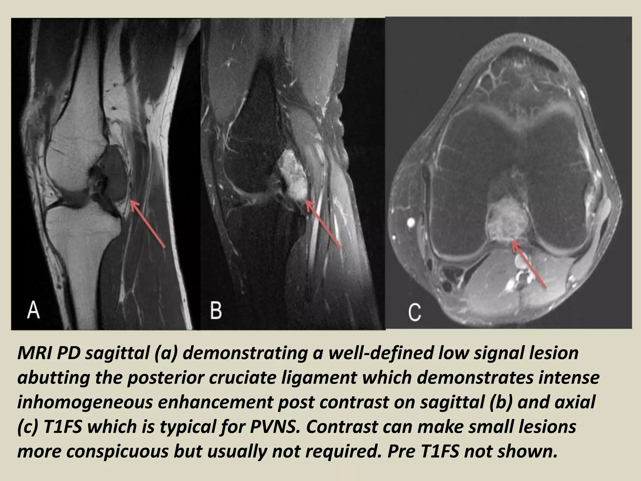 Presentation1, radiological imaging of popliteal fossa masses. | PPTX