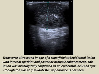 Presentation1, radiological imaging of popliteal fossa masses. | PPTX