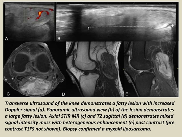 Presentation1, radiological imaging of popliteal fossa masses. | PPT