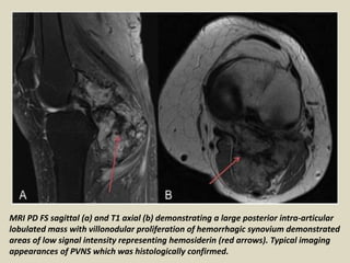 Popliteal Lymph Nodes Mri